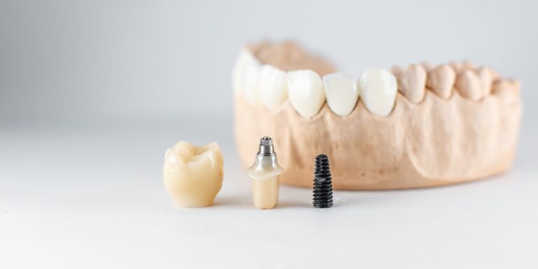 ⊛ ¿Qué es un perno dental y para qué se utiliza? ⊛ ¿Qué es un perno dental y para qué se utiliza?